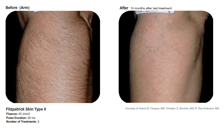 Alphamedix | Skin type II Courtesy of Valeria B.CamposMD Chrisitne C ...
