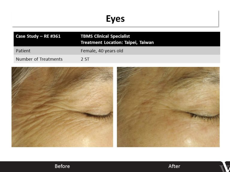 Alphamedix | V-ST Eyes - Alphamedix