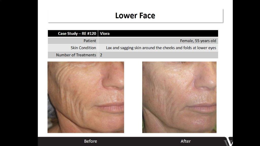 Alphamedix | V-ST Lower face - Alphamedix