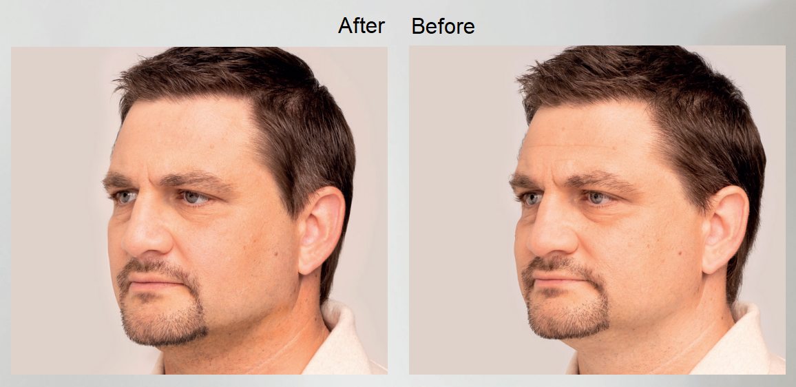 Alphamedix | Belotero for men - Alphamedix